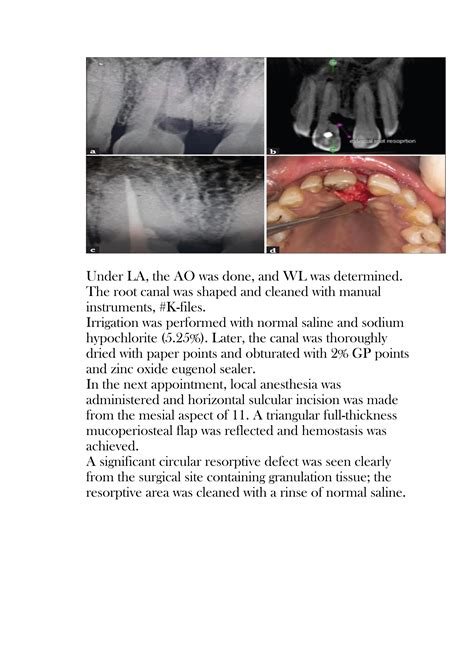 Jc 2 Ecr External Cervical Resorption In Adult Tooth Pdf Free Download