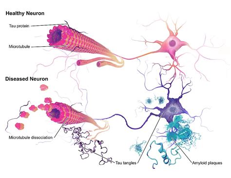 Filealzheimers Disease Wikipedia