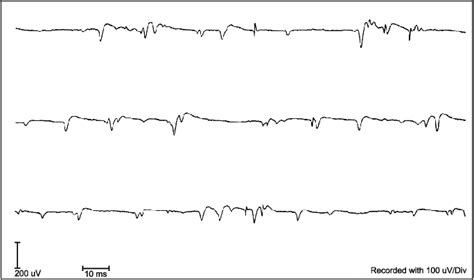 Emg Findings Showed Positive Sharp Waves And Fibrillations In The Right