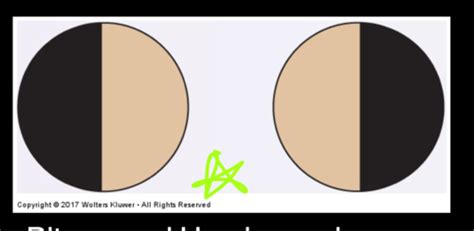 Pt Assessment Heent Flashcards Quizlet