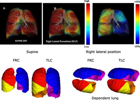 Regional Ventilation Maps For A Healthy Subject In Supine A And Right Download Scientific