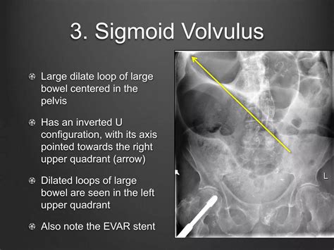 Approach To Pfa Interpretation Pptx Digestive Disorders Diseases And Conditions