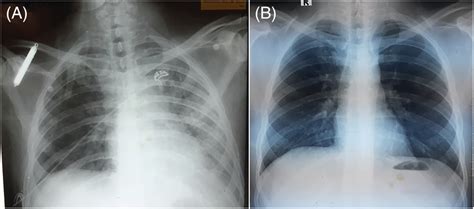 A Chest X‐ray Cxr Done On Admission Showing Left‐sided Download Scientific Diagram
