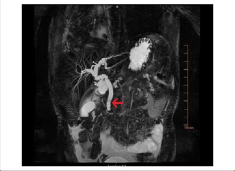 Magnetic Resonance Cholangiopancreatography On Day 26 Showing Download Scientific Diagram