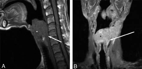 A 64 Year Old Man With Laryngeal Lymphoma A Sagittal T1 Weighted Mr
