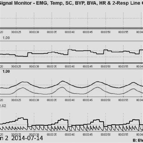A Dysfunctional Breathing Pattern In A Young Man With Frequent Seizures Download Scientific
