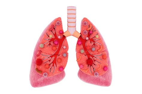 Best Hospital For Lobectomy Surgery In India Medisuggest