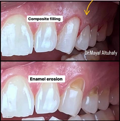 Mayaf Altuhafy On Linkedin Class V Cavities Include Caries Or Defects Of Non Carious Origin…