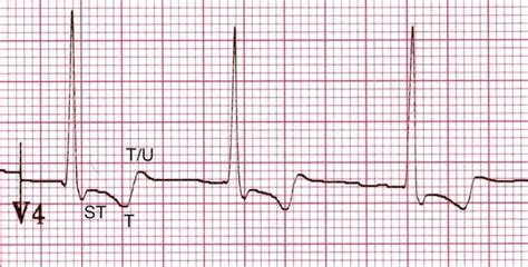 Digoxin Effect • Litfl • Ecg Library Toxicology Digoxin Effect • Litfl • Ecg Library Toxicology