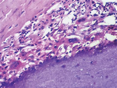 A Definitive Diagnosis Is Based On The Histology And Confirmed By The