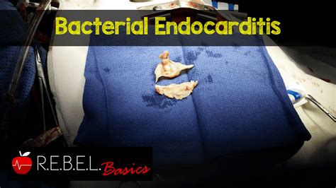 Bacterial Endocarditis Rebel Em Emergency Medicine Blog