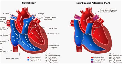 Natalie Rose Daily Update Of Our Micro Preemie PDA Ligation Surgery Part