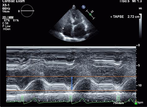How To Do Tapse In Echo At Fernando Smith Blog