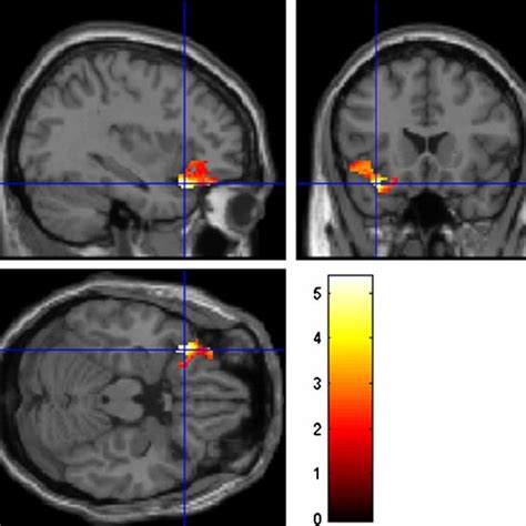 Significant Flexible Factorial Results In Within Patient Comparisons