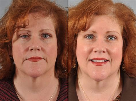 Saggy Eyelids Treatments For Droopy Eyelids In Costa Rica Ptosis