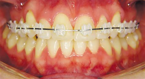 Metal Bracket Braces