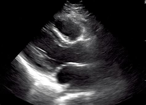 Practical Pocus On Linkedin Pocus Ultrasound Medicalimaging Emergencymedicine