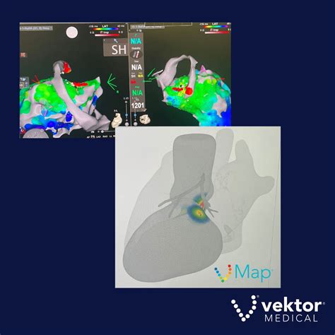 Vektor Medical Inc On Linkedin Vmap Carto Vmap