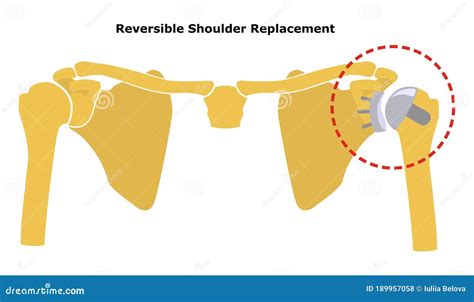 Reversible Shoulder Replacement Shoulder Joint Replacement