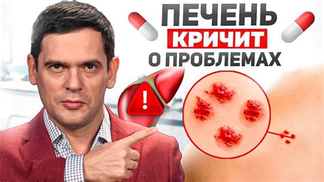 5 Самых РАННИХ Симптомов Проблем с Печенью НЕ ИГНОРИРУЙ ИХ Youtube