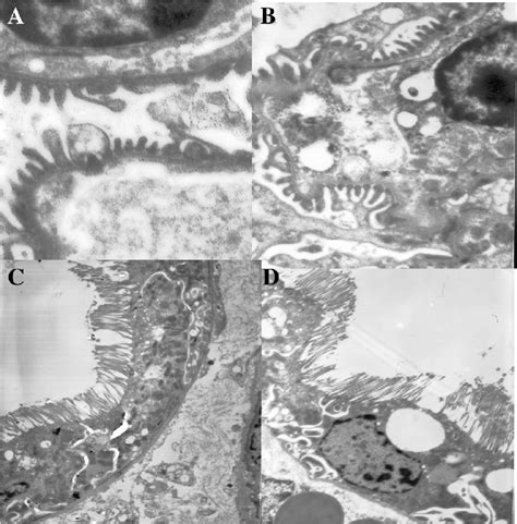 Electron Microscopy Showed Glomerular Capillary Endothelium And Tubular