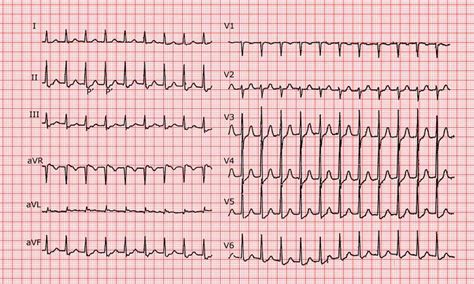 10 Triggers Of AVNRT You Must Know Cardiovasculardiseasehub Com