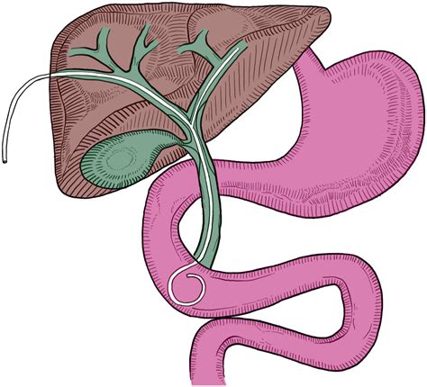 Management Of Acute Cholangitis And Choledocholithiasis Surgical Clinics Management Of Acute Cholangitis And Choledocholithiasis Surgical Clinics