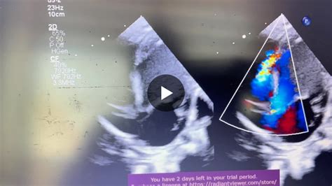 4m Old 4kg Apical Muscular Vsd Highly Symptomatic Patient We