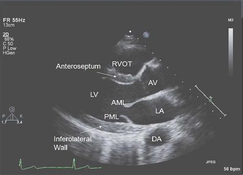 Echocardiogram Transesophageal Transthoracic Stress Echocardiogram