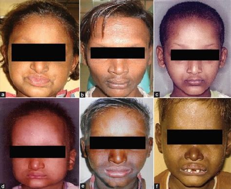 Extra Oral Photographs Of Patients With Ectodermal Dysplasia Download Scientific Diagram Extra Oral Photographs Of Patients With Ectodermal Dysplasia Download Scientific Diagram