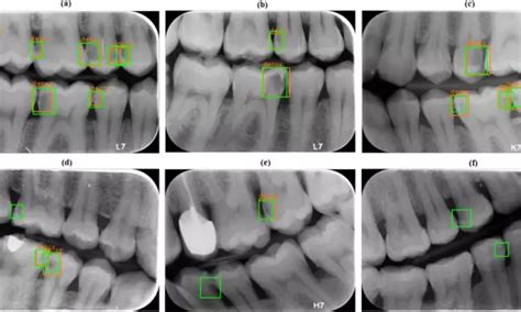 Artificial Intelligence May Help Detect Proximal Caries On Bitewing X