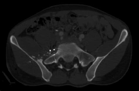 Cortical Irregularity In The Right Iliac Bone And Foreign Body