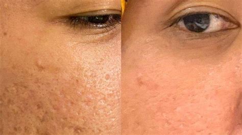 Penjelasan Dokter Tentang Faktor Penyebab Bopeng Yang Seringkali Mengganggu Penampilan