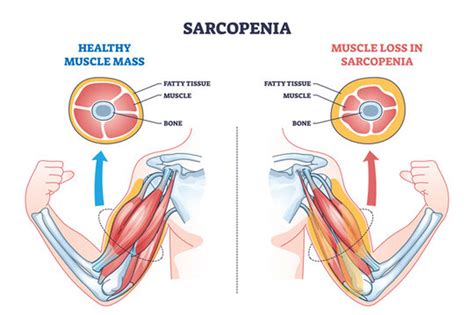 Old Age Sucks What Is Sarcopenia And How To Reverse It Long Life And Health