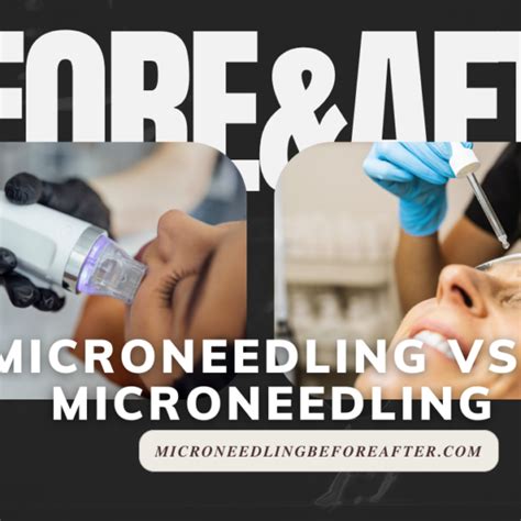 Microneedling Depth Chart
