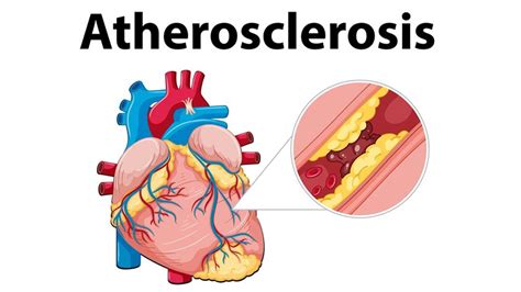 Is Atherosclerosis Caused By High Cholesterol