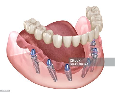 하 악 보 철물 모든 6 시스템 임 플 란 트에 의해 지원 인간의 치아와 의치 개념의 의학적으로 정확한 3d 그림