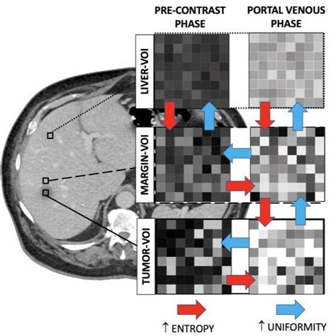 Comparison Of Entropy And Uniformity Of Tumor Margin And Liver Volume