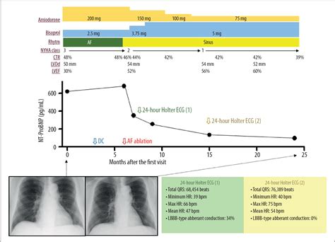 Figure 1 From A Patient With Left Bundle Branch Block And Persistent