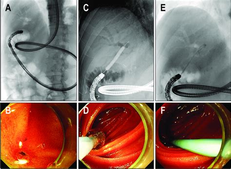The Procedure Of Single Balloon Enteroscopy Endoscopic Retrograde Download Scientific Diagram