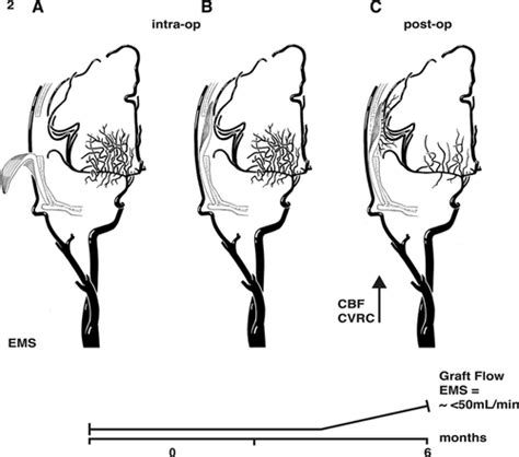 Surgical Management Of Moyamoya Disease Stroke