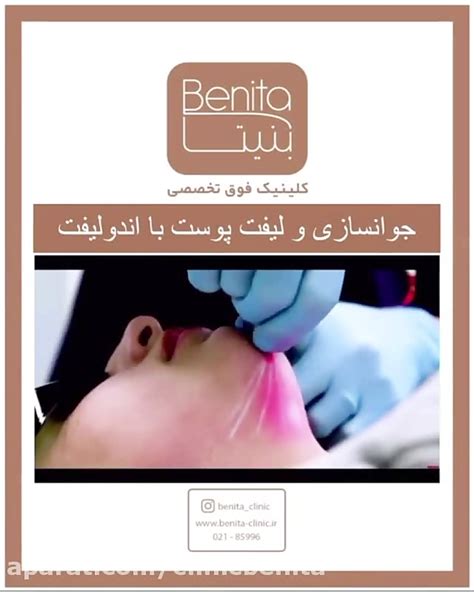 جوانسازی و لیفت پوست با اندولیفت