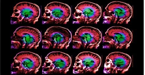 Types Of Brain Scans StudyPK