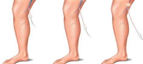 КАК ДА РАЗПОЗНАЕМ ПРИЗНАЦИТЕ ЗА РАЗШИРЕНИ ВЕНИ