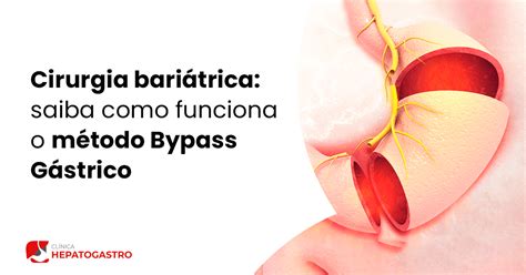 Cirurgia Bariátrica: Saiba Como Funciona O Método Bypass Gástrico - Clínica Hepatogastro