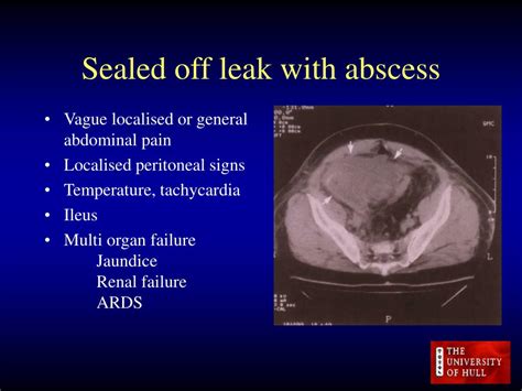 Ppt The Management Of Anastomotic Leak Powerpoint Presentation Free