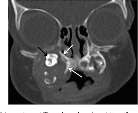 Melanotic Neuroectodermal Tumor Of Infancy