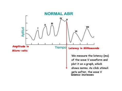 Brainstem Auditory Evoked Responses Baer Or Abr
