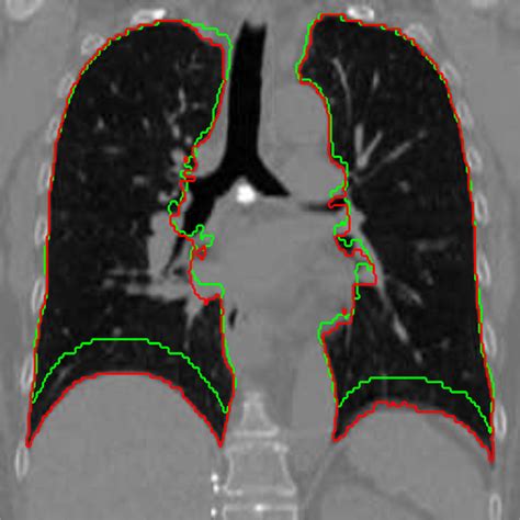 example of superimposed lung segmentations in inhale state red and