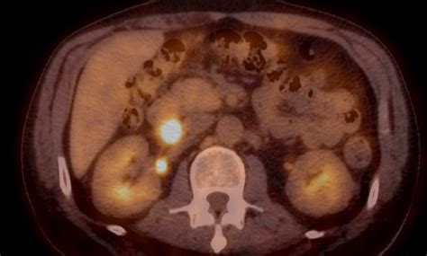 Petct Scan Of Gist Tumor In 3 Rd Portion Of Duodenum Pet